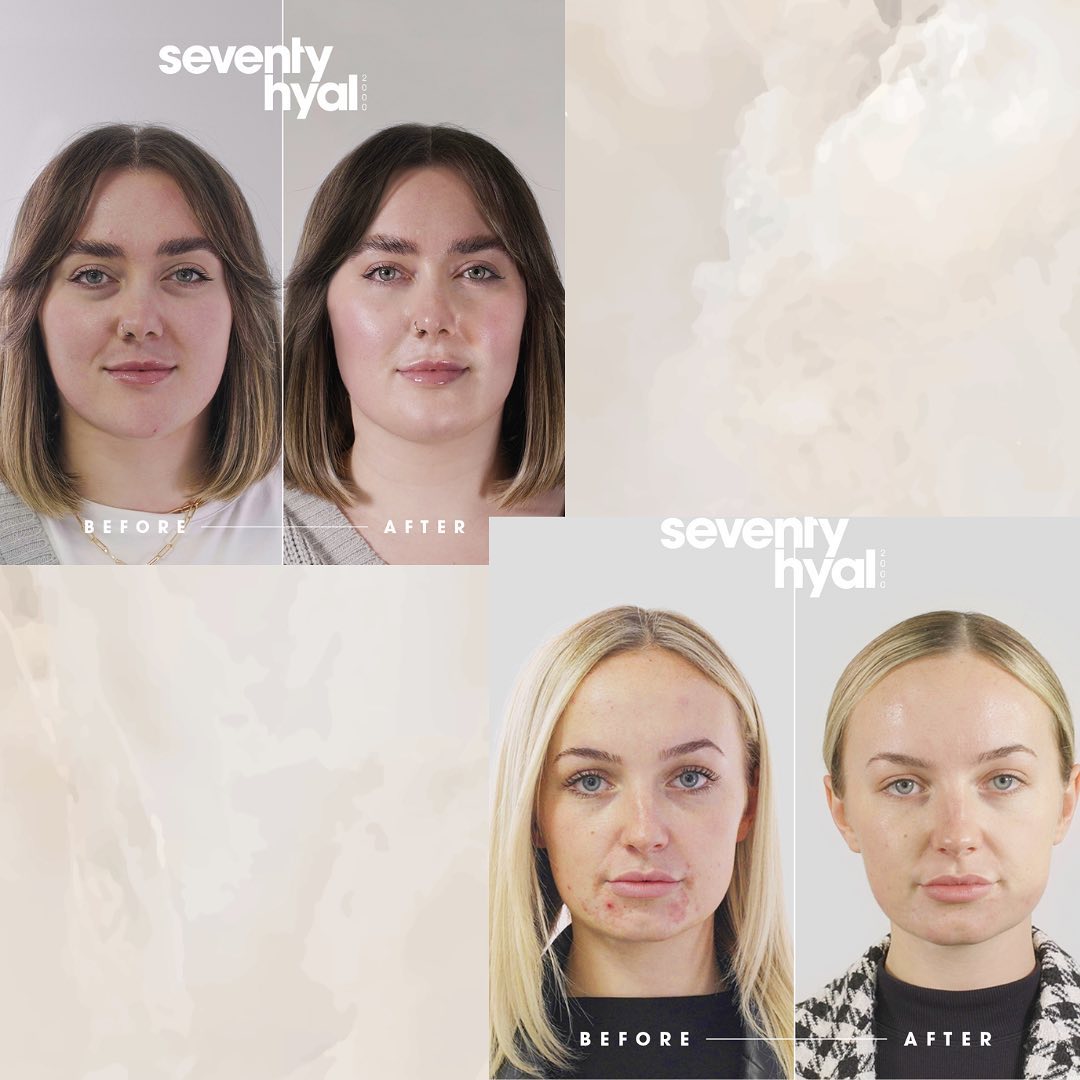 Seventy-Hyal Treatment – MJ Aesthetics
